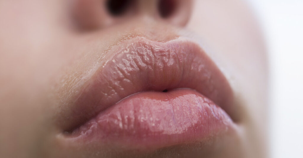 Botched Lip Filler Injection Has Influencer Speaking Out