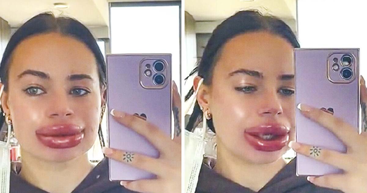 Botched Lip Filler Injection Has Influencer Speaking Out